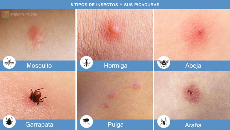 ¿Qué hacer si bebés y niños sufren picaduras por insectos?